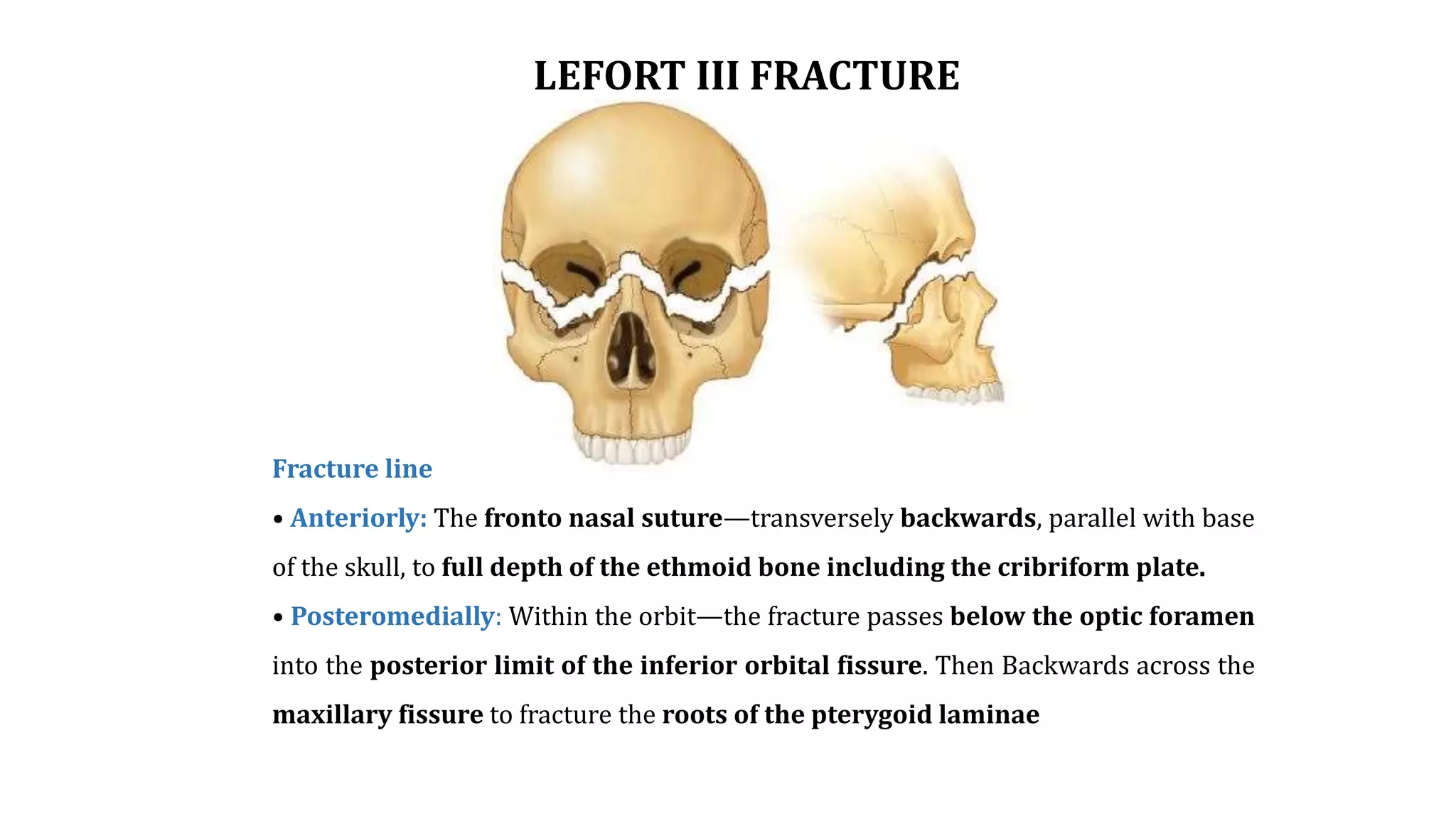 LEFORT FRACTURES.pptx