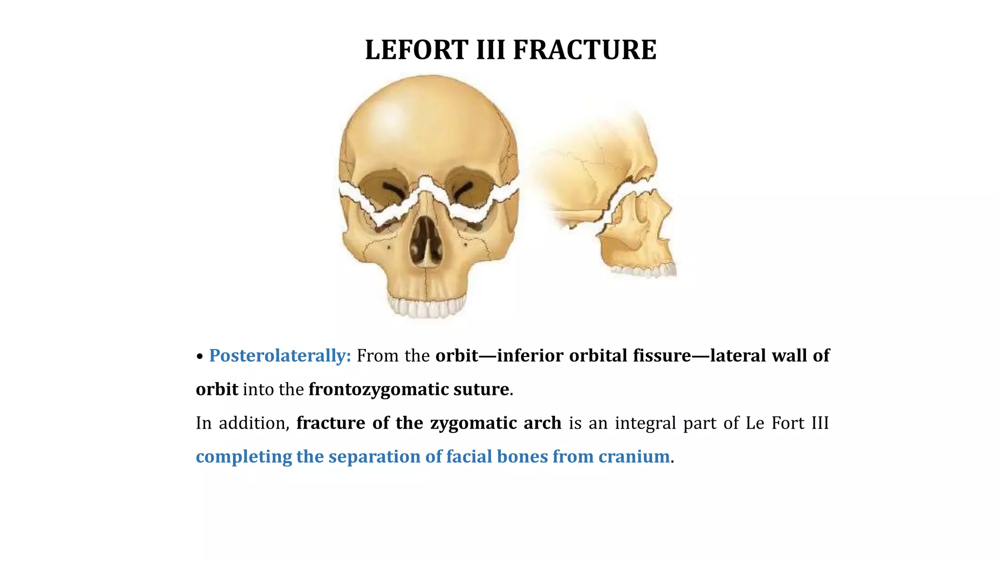 LEFORT FRACTURES.pptx