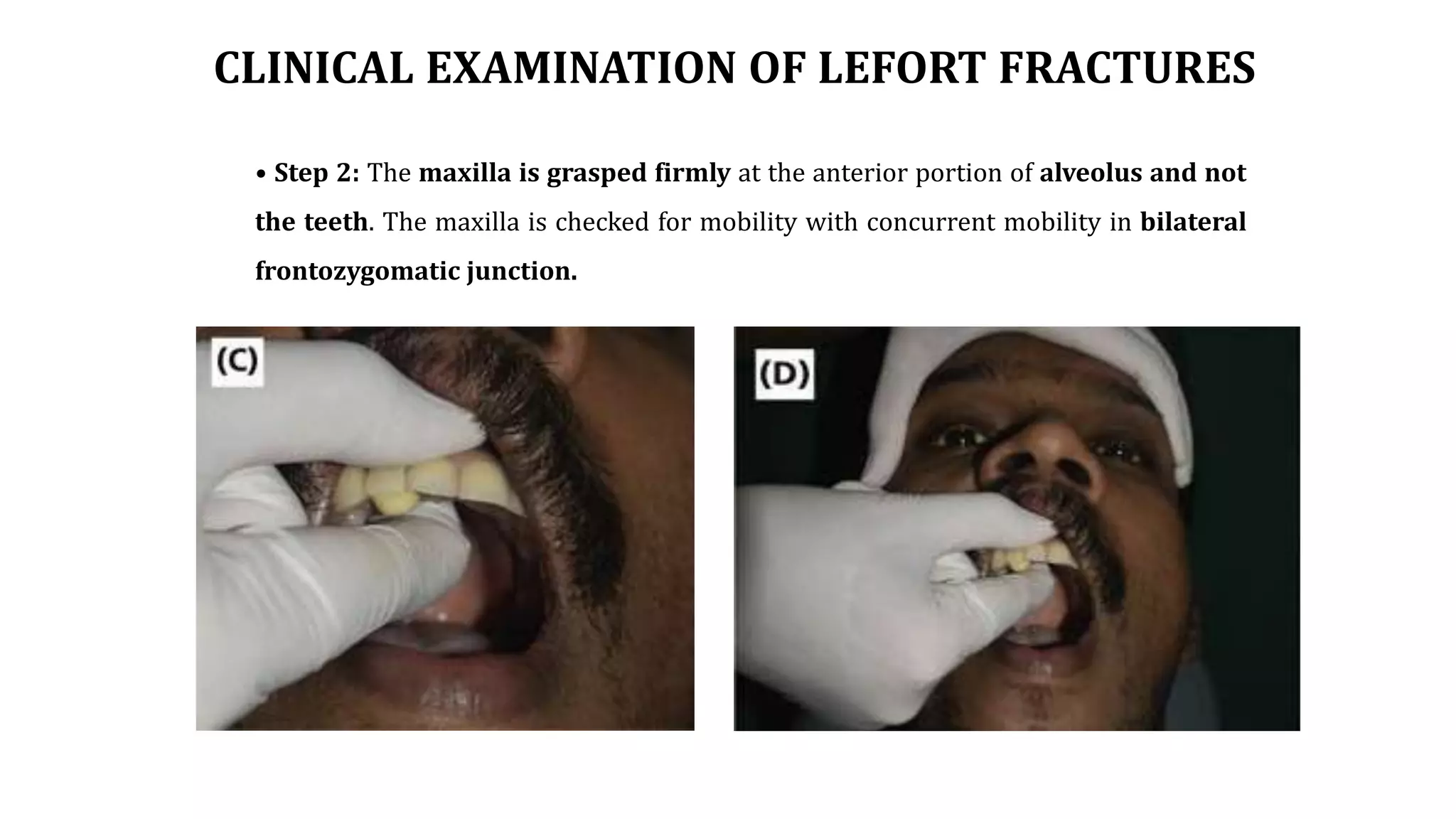 LEFORT FRACTURES.pptx