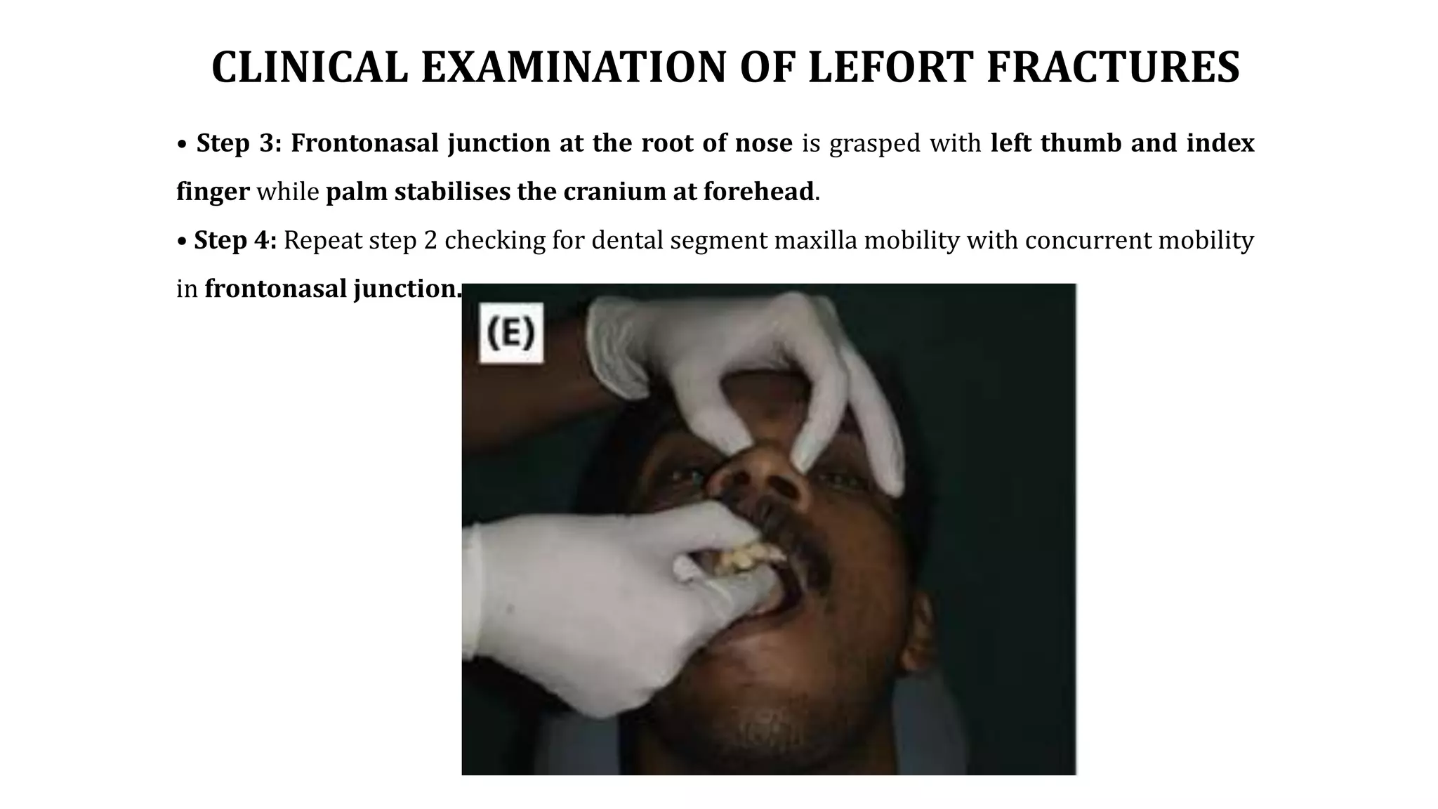LEFORT FRACTURES.pptx