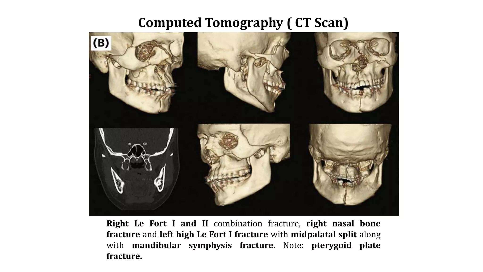 LEFORT FRACTURES.pptx