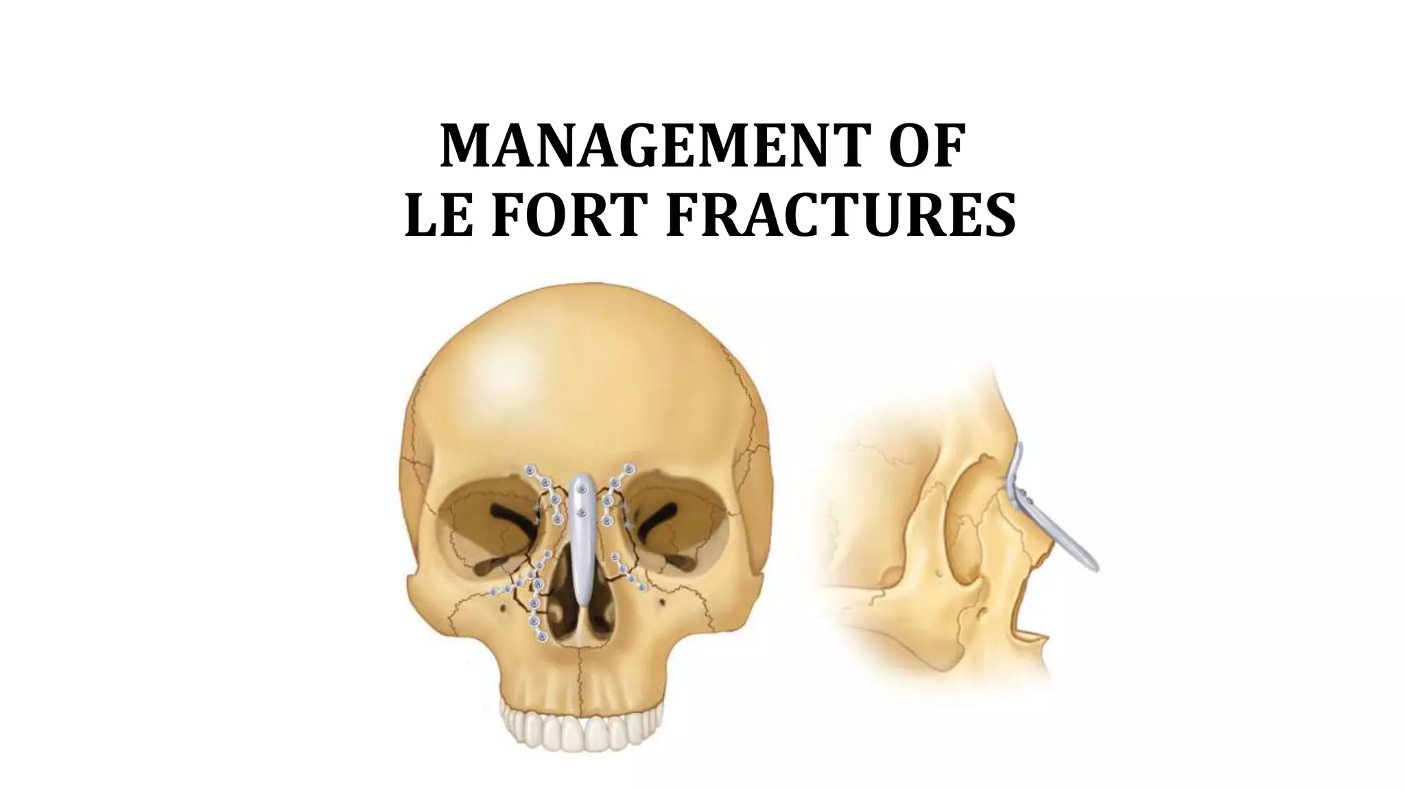 LEFORT FRACTURES.pptx