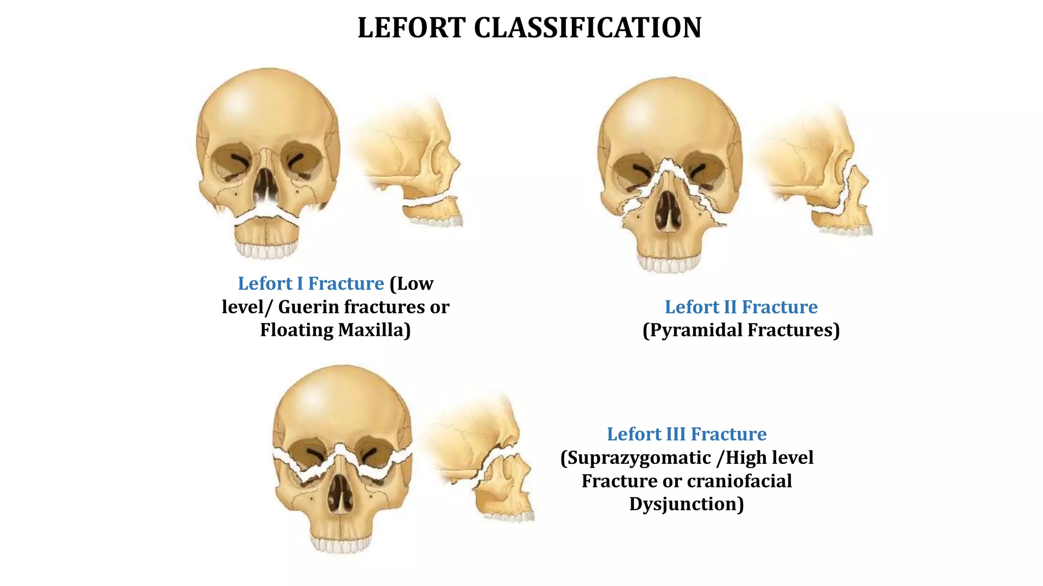 LEFORT FRACTURES.pptx