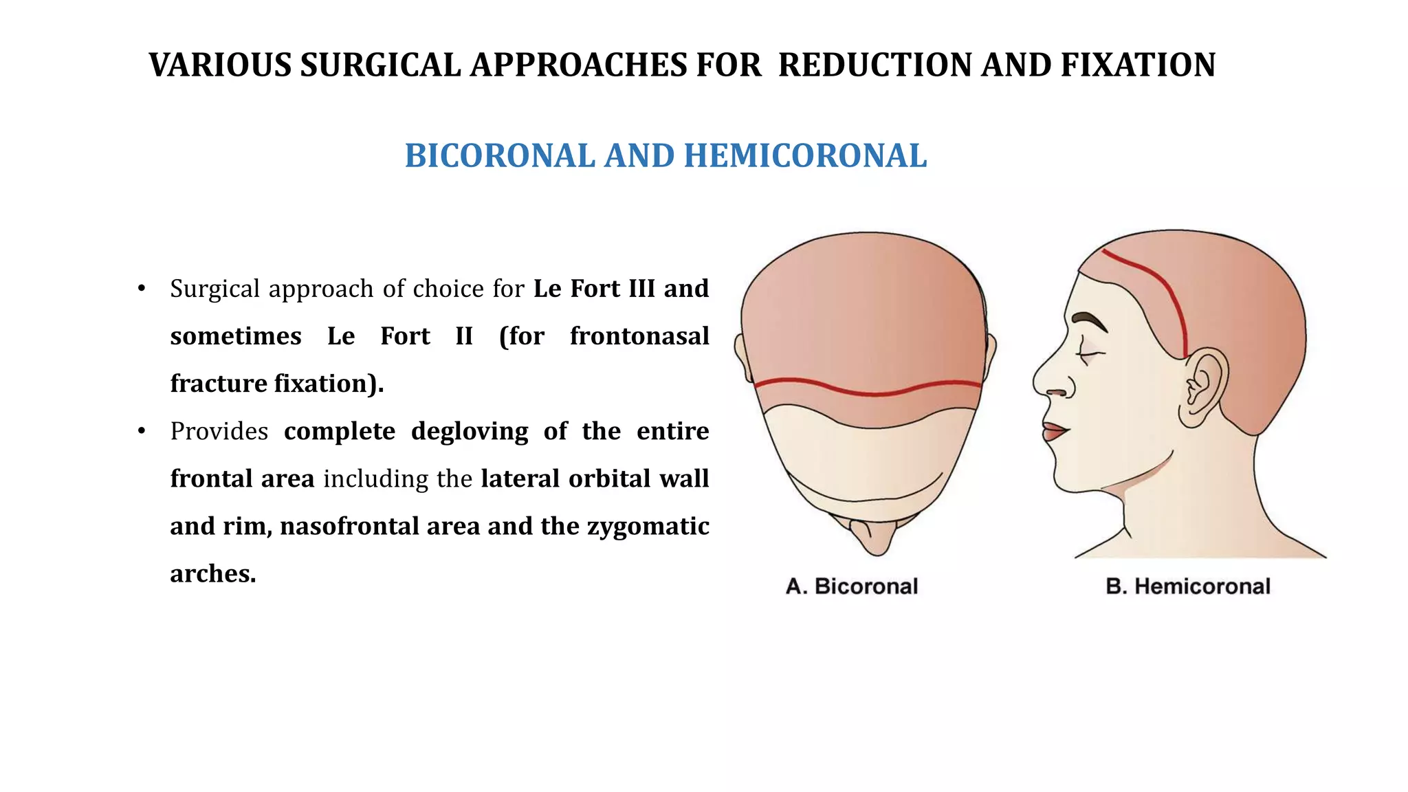 LEFORT FRACTURES.pptx