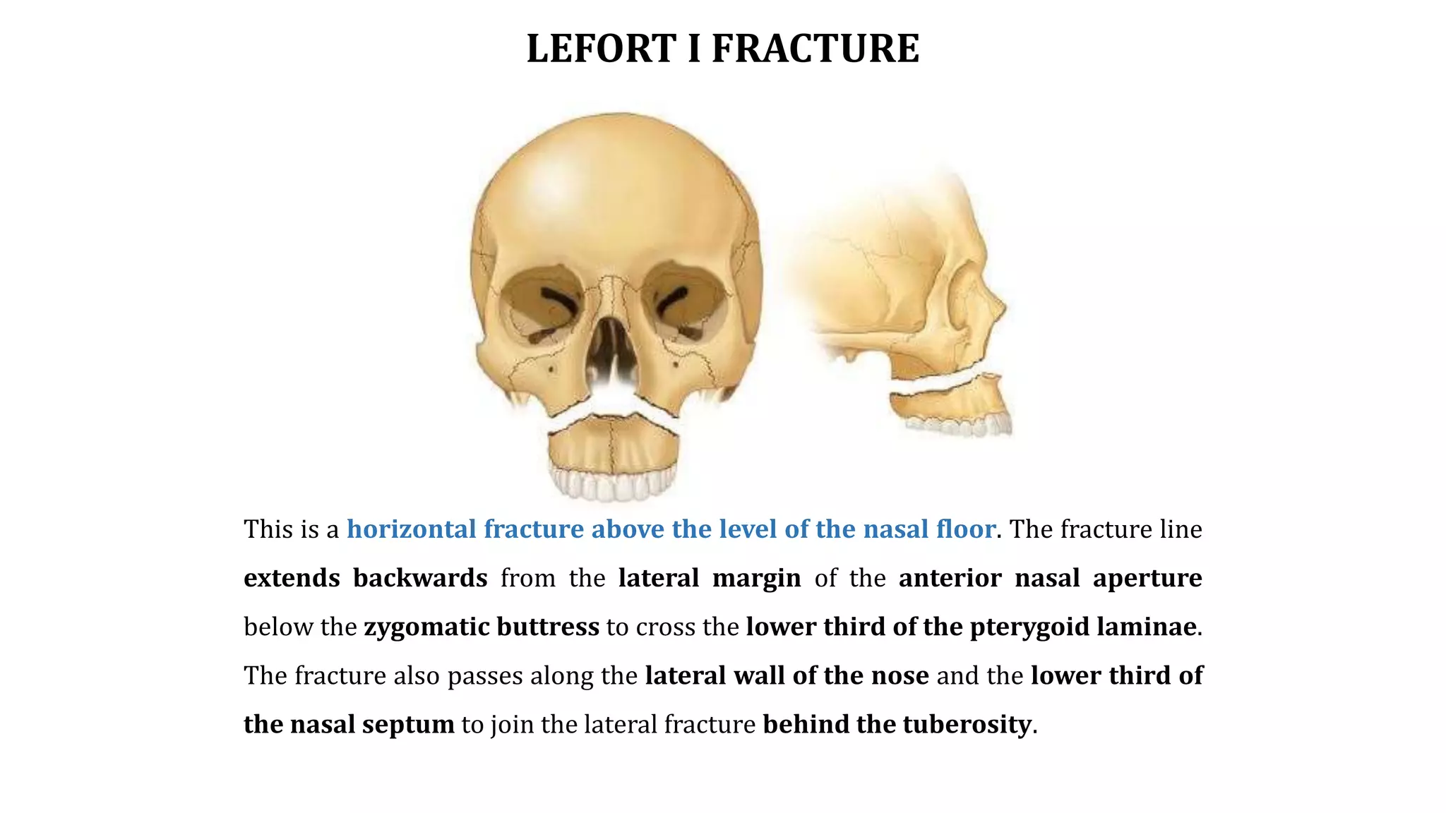 LEFORT FRACTURES.pptx
