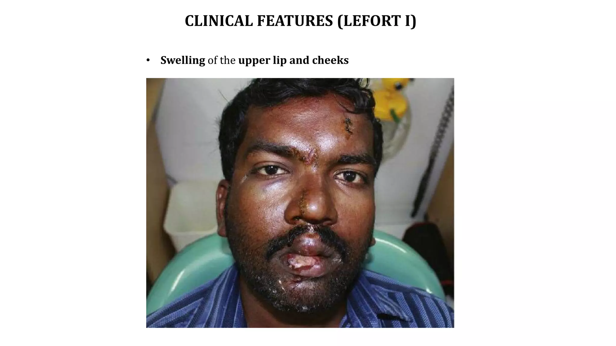 LEFORT FRACTURES.pptx