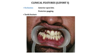 LEFORT FRACTURES.pptx