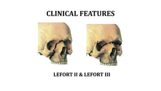 LEFORT FRACTURES.pptx