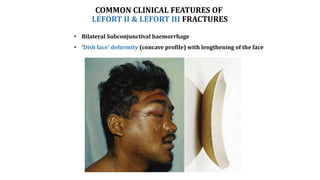 LEFORT FRACTURES.pptx