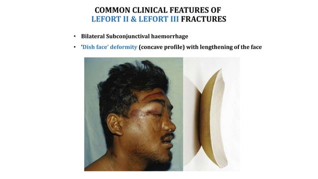 LEFORT FRACTURES.pptx | Death, Injury, or Military Conflict | Sensitive ...
