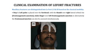 LEFORT FRACTURES.pptx