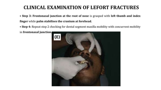 LEFORT FRACTURES.pptx | Death, Injury, or Military Conflict | Sensitive ...