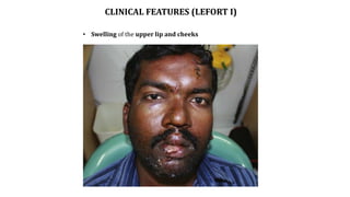 LEFORT FRACTURES.pptx