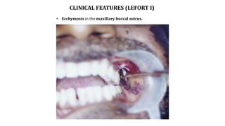 LEFORT FRACTURES.pptx