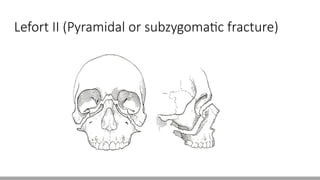 LE FORT FRACTURES AND THEIR MANAGEMENT.pptx