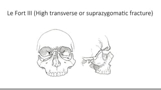 LE FORT FRACTURES AND THEIR MANAGEMENT.pptx