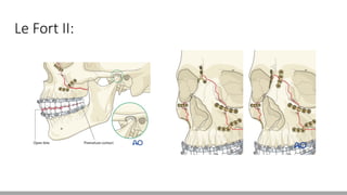 LE FORT FRACTURES AND THEIR MANAGEMENT.pptx