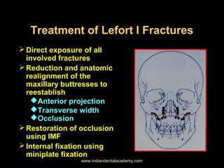 Lefort fractures /certified fixed orthodontic courses by Indian dental ...