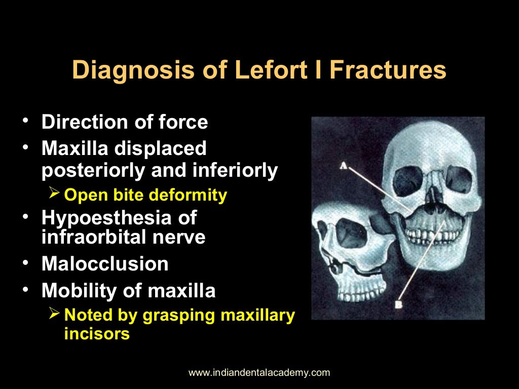 Lefort fractures /certified fixed orthodontic courses by Indian denta…