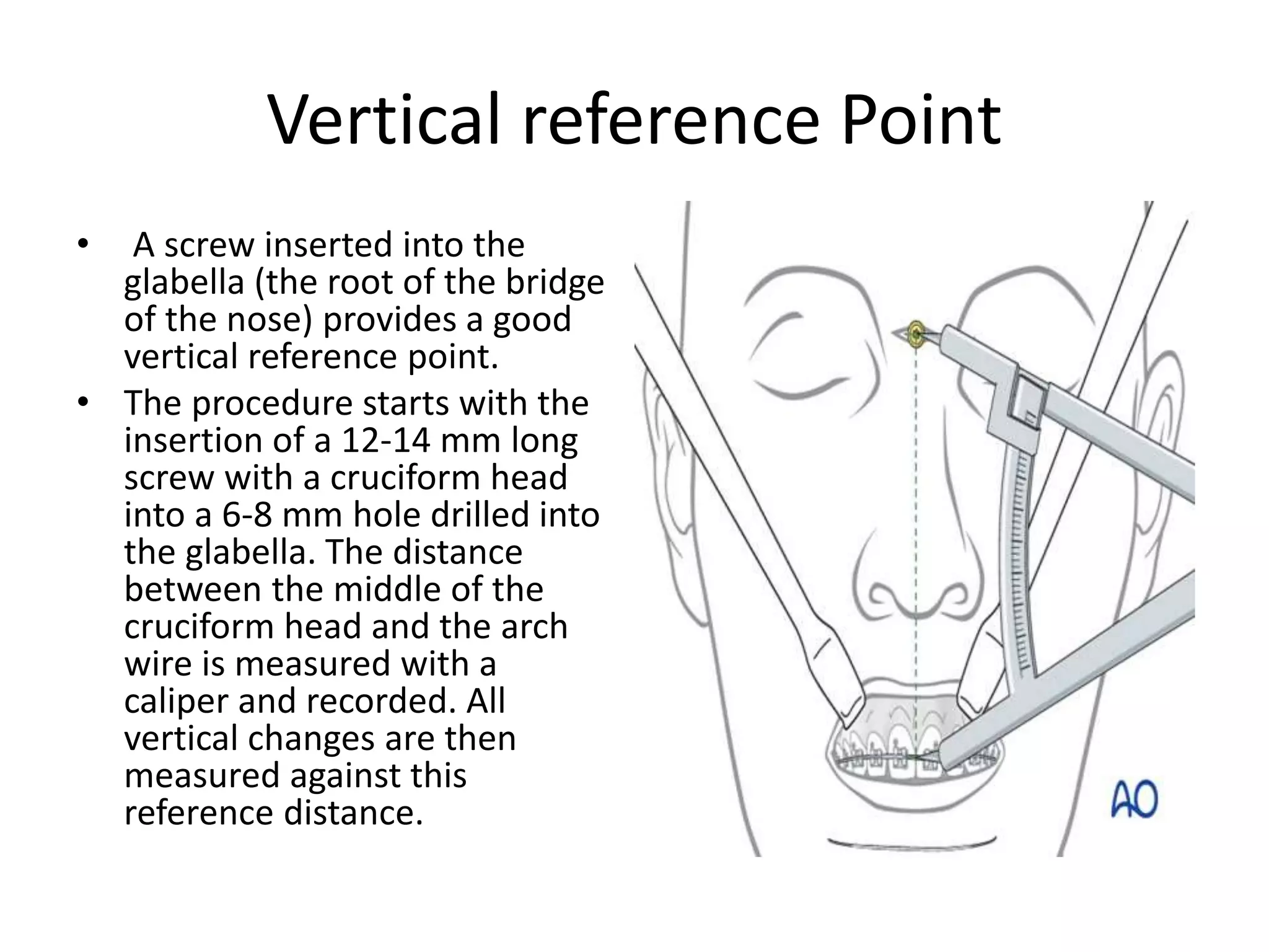 Le fort i maxillary osteotomy | PPTX