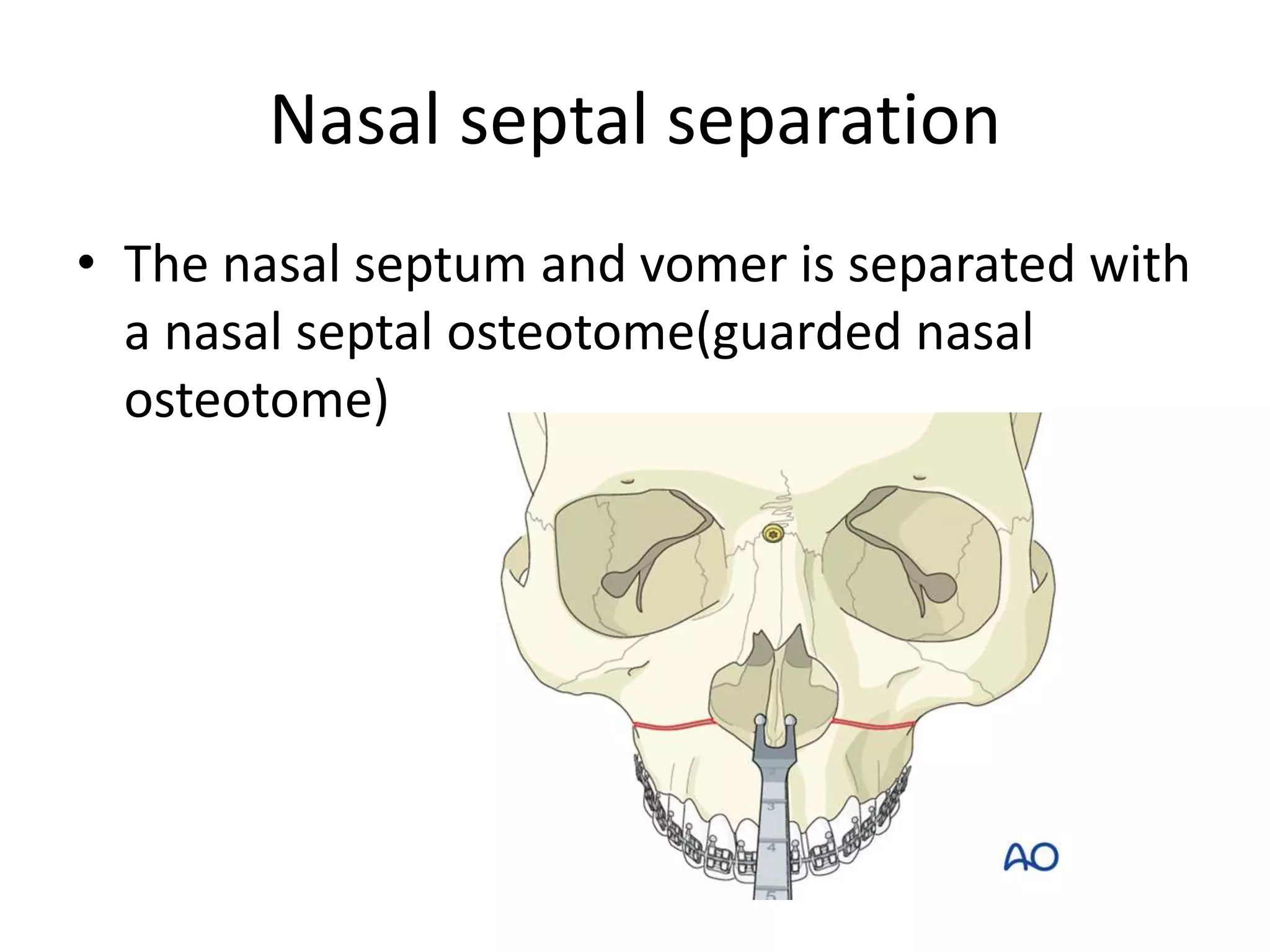 Le fort i maxillary osteotomy | PPTX