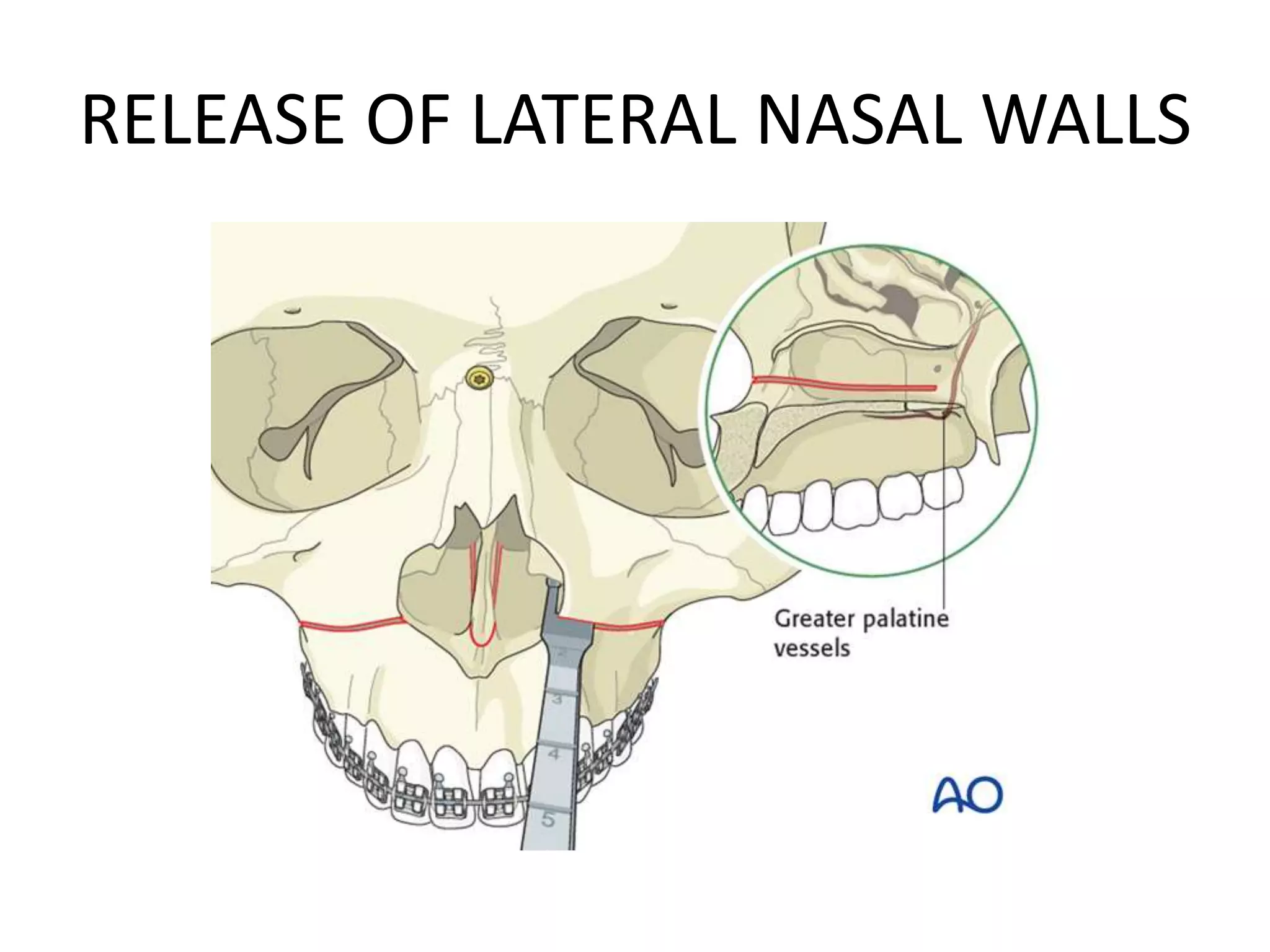 Le fort i maxillary osteotomy | PPTX