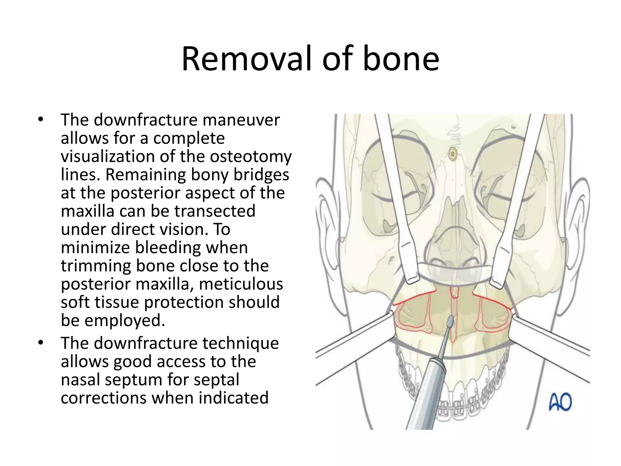 Le fort i maxillary osteotomy | PPTX