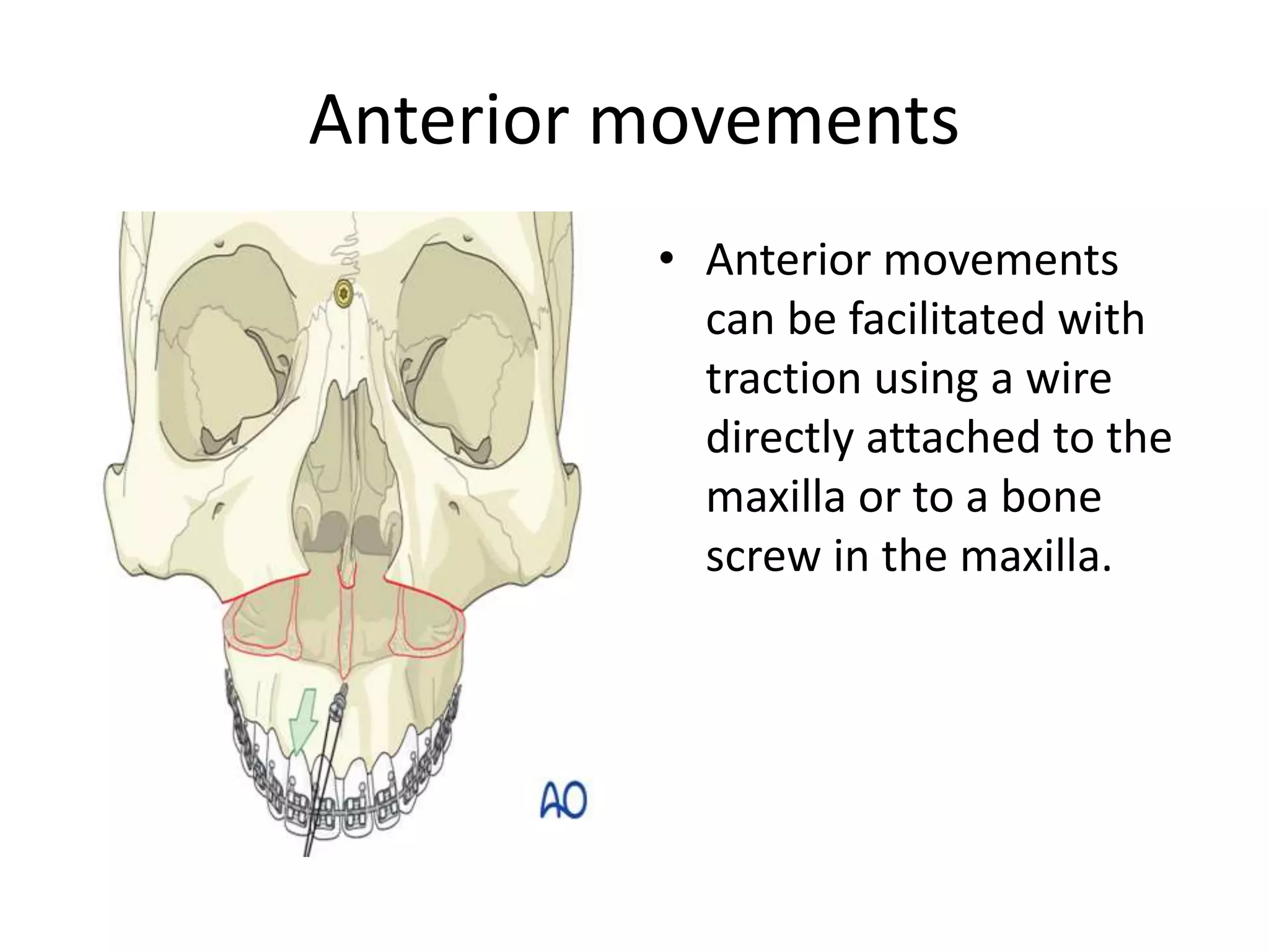 Le fort i maxillary osteotomy | PPTX