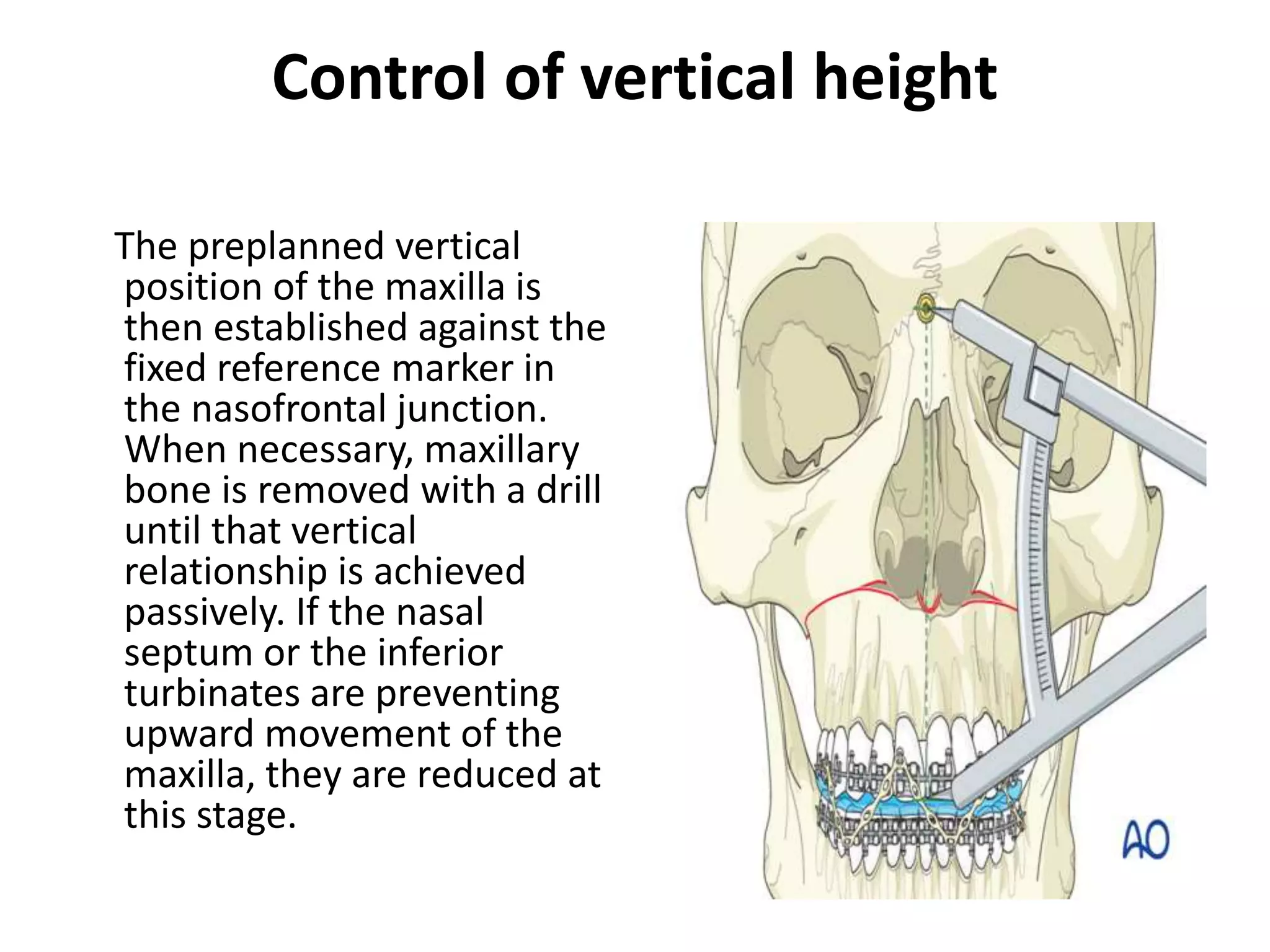 Le fort i maxillary osteotomy | PPTX