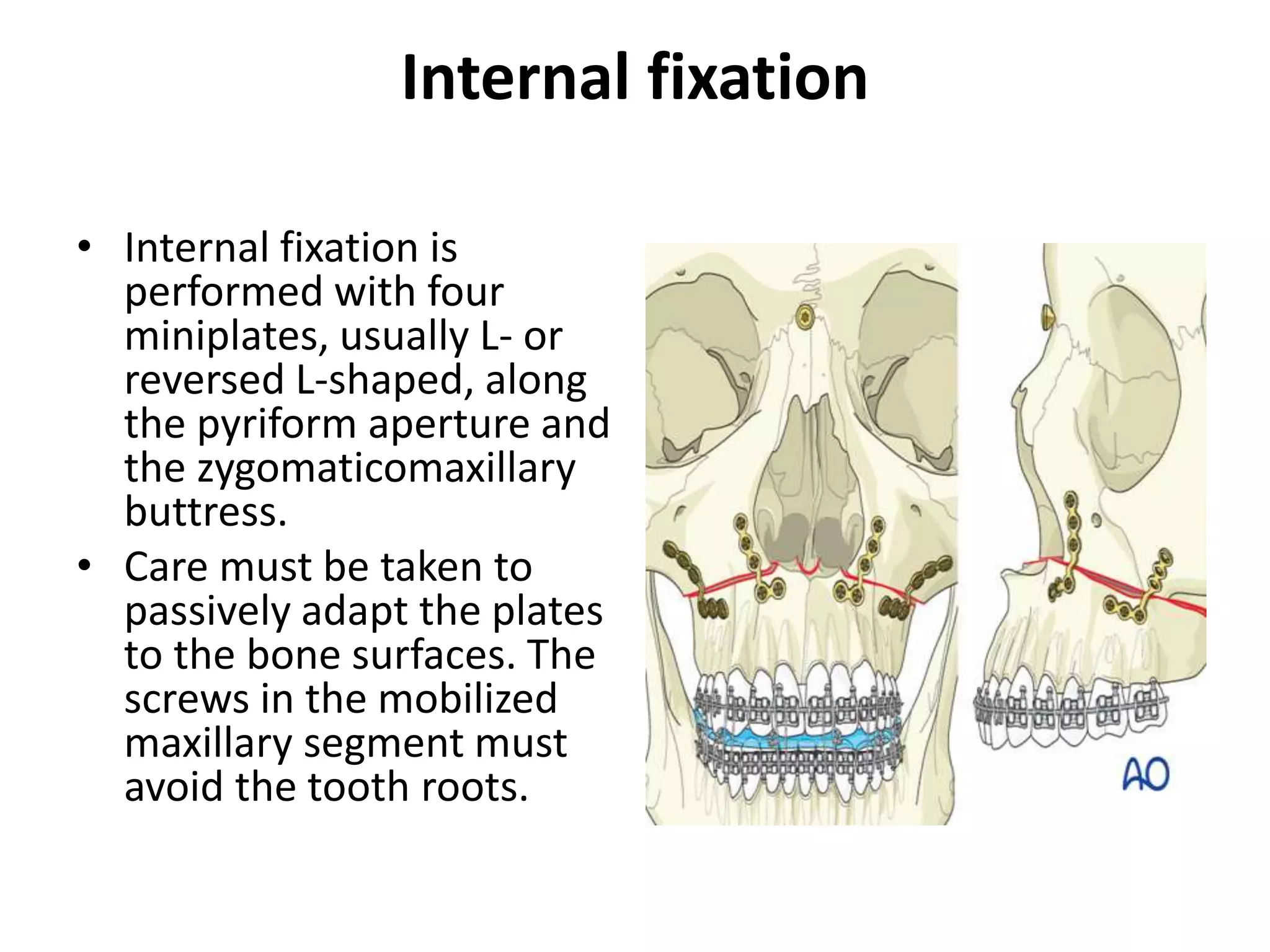 Le fort i maxillary osteotomy | PPTX
