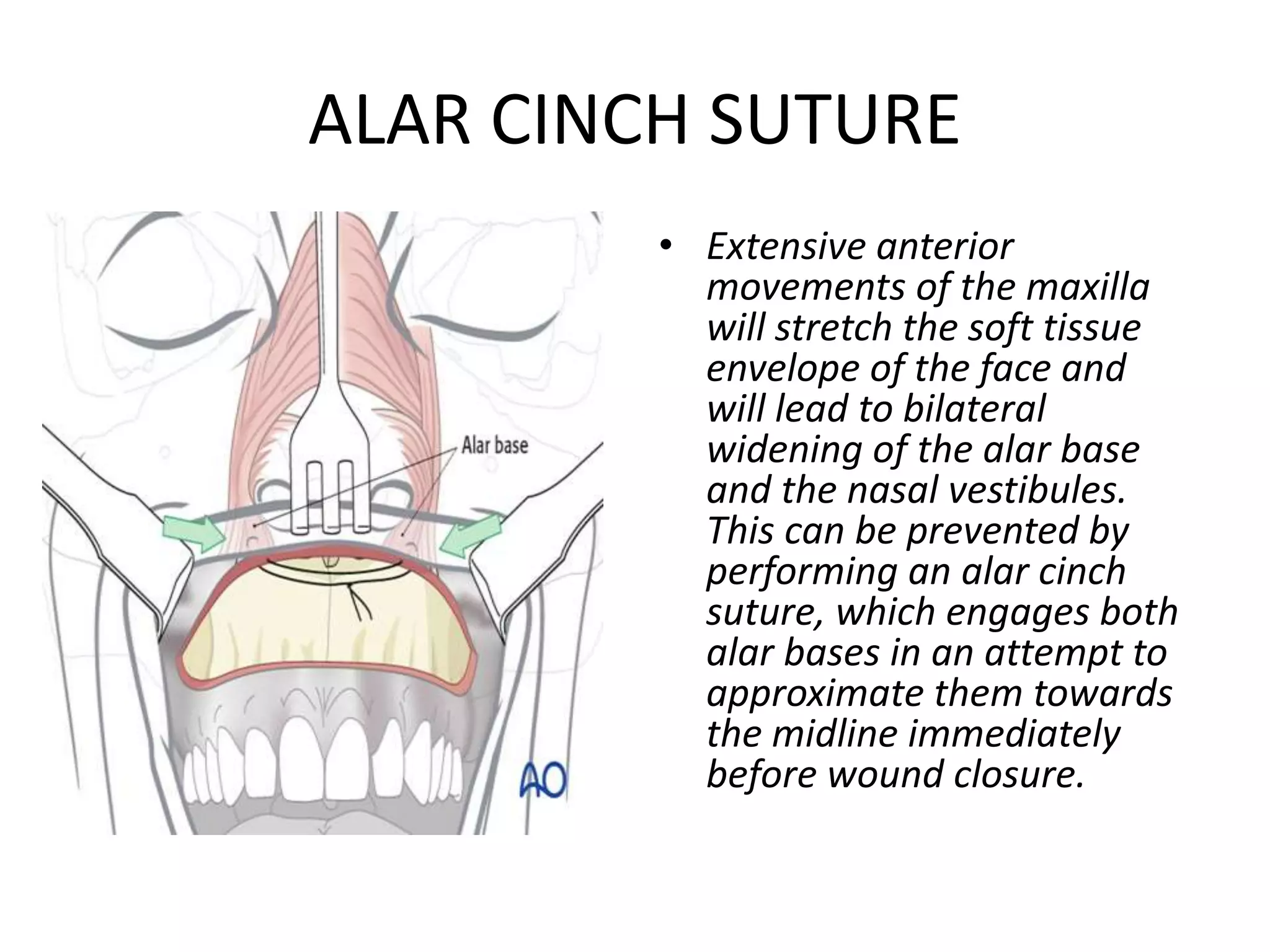 Le fort i maxillary osteotomy | PPTX