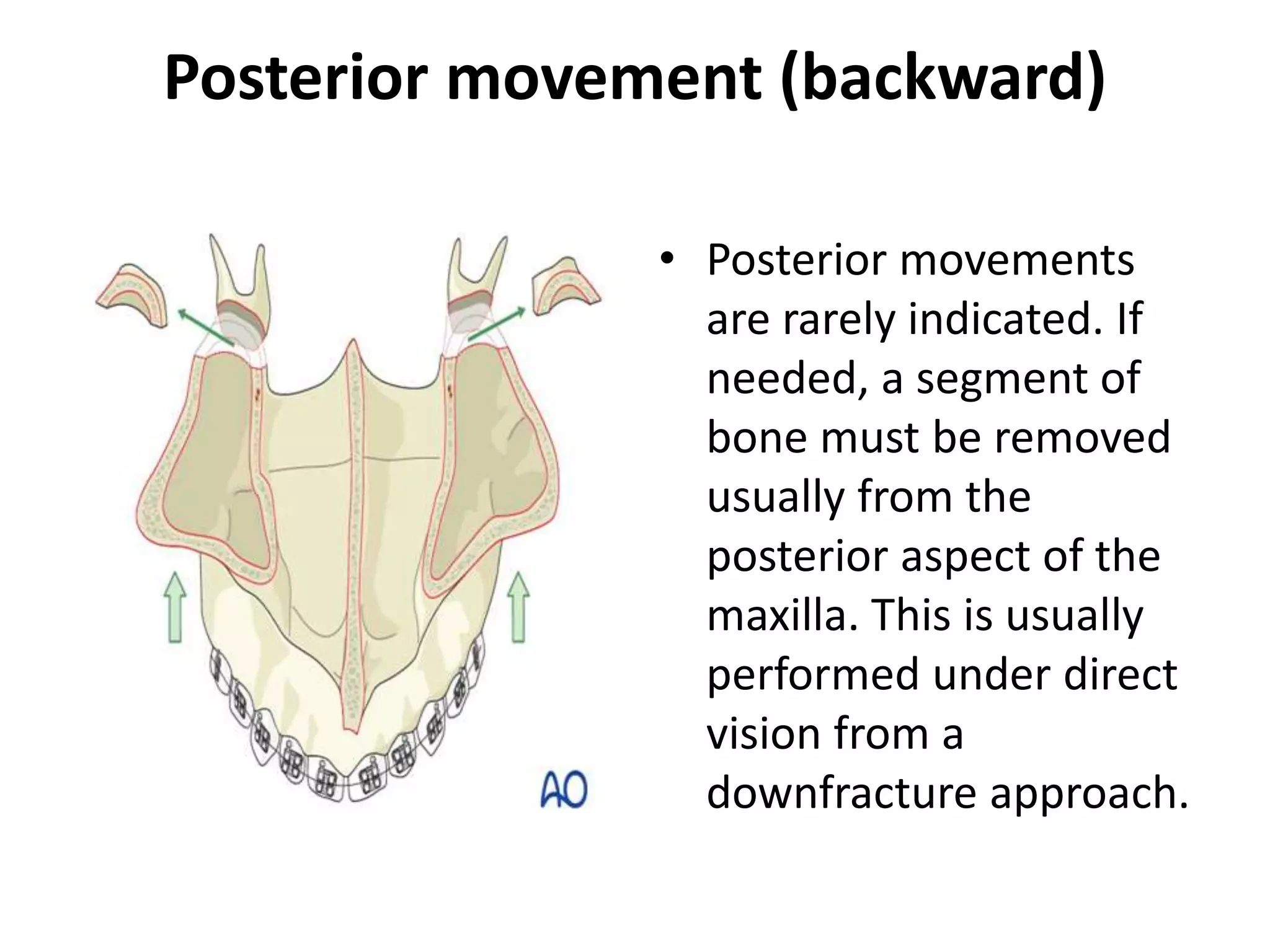Le fort i maxillary osteotomy | PPTX
