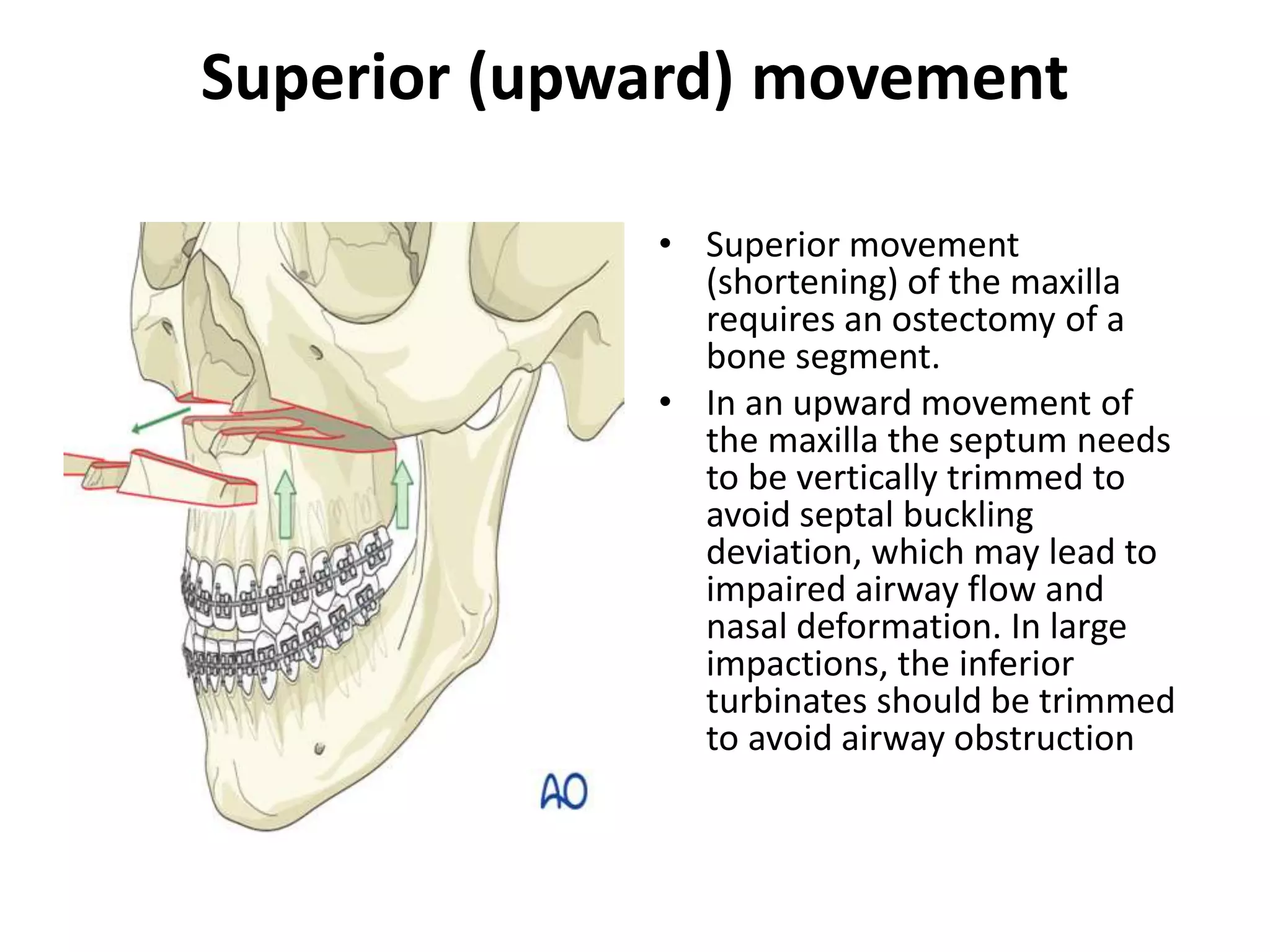 Le fort i maxillary osteotomy | PPTX