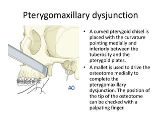 Le fort i maxillary osteotomy | PPTX