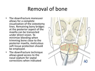 Le fort i maxillary osteotomy | PPTX