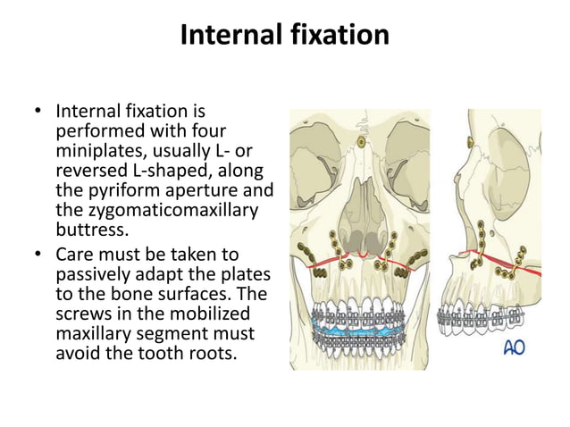 Le fort i maxillary osteotomy | PPTX