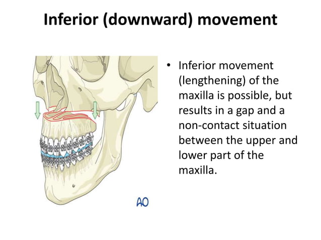 Le fort i maxillary osteotomy | PPTX