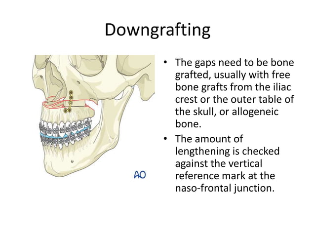 Le fort i maxillary osteotomy | PPTX