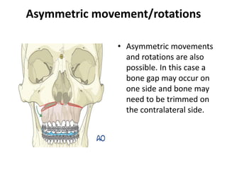Le fort i maxillary osteotomy | PPTX