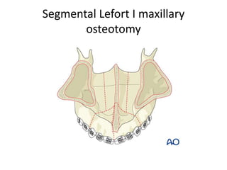 Le fort i maxillary osteotomy | PPTX