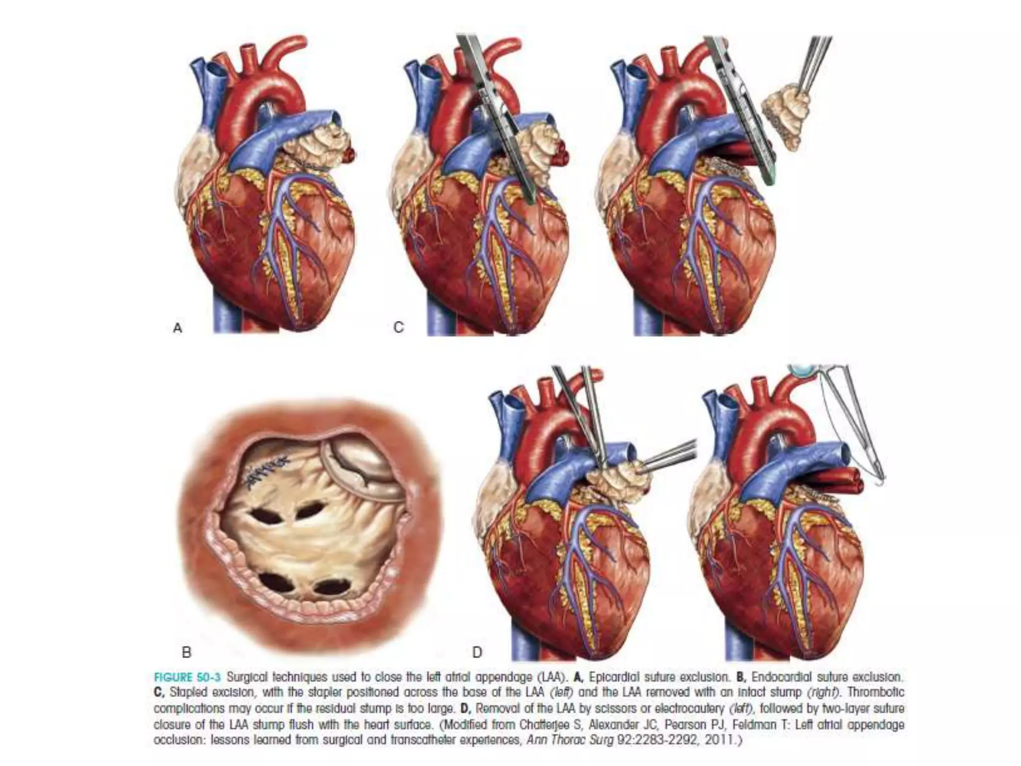 Left atrial appendage closure | PPTX