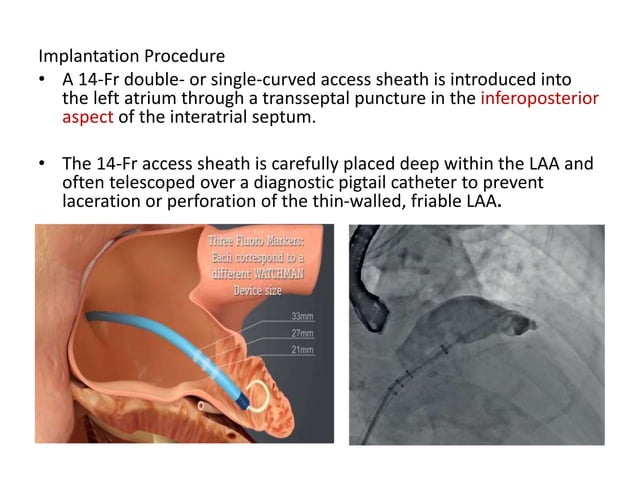 Left atrial appendage closure | PPTX