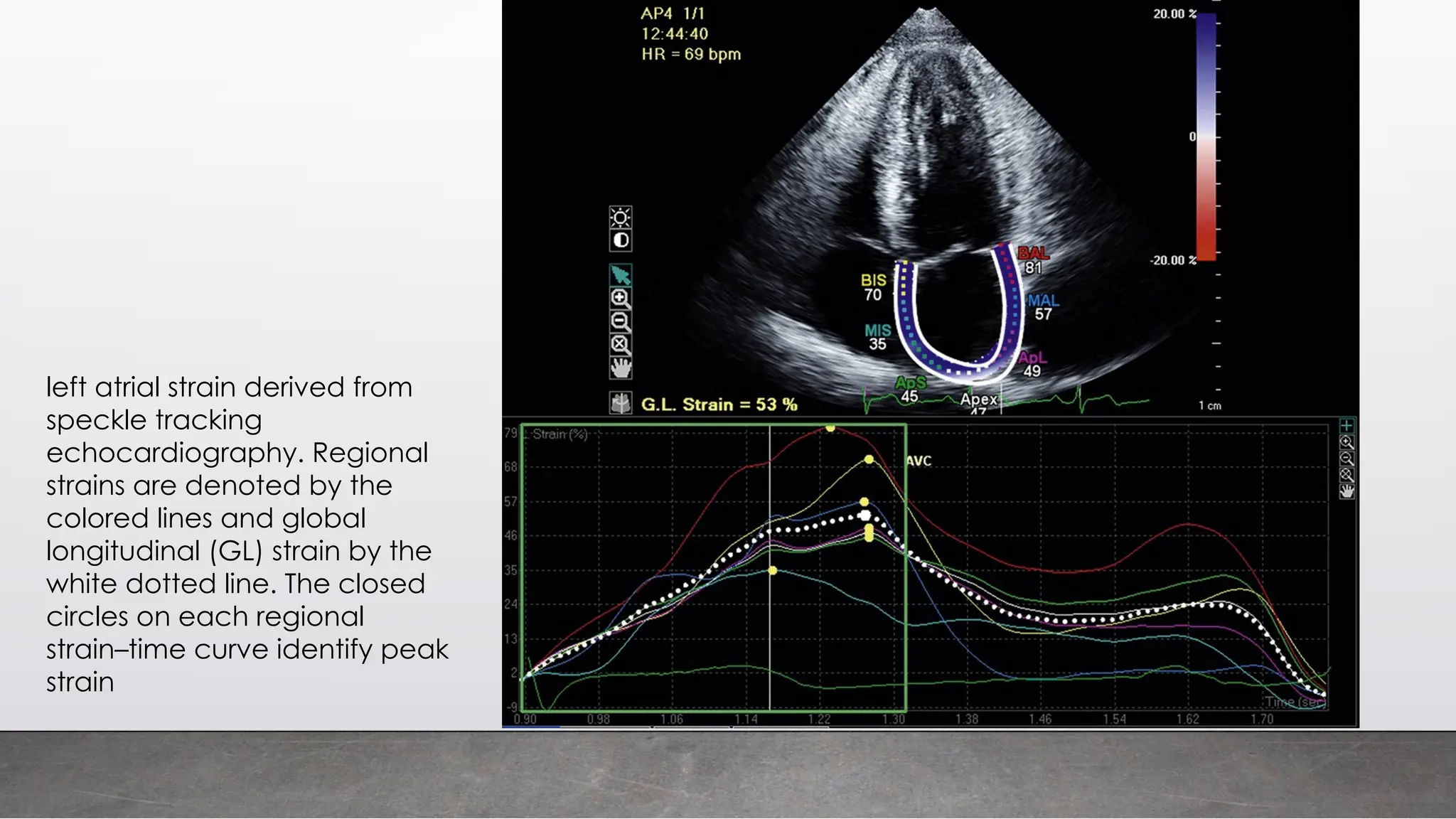 ECHOCARDIOGRAPHY left atrium size and function.pptx