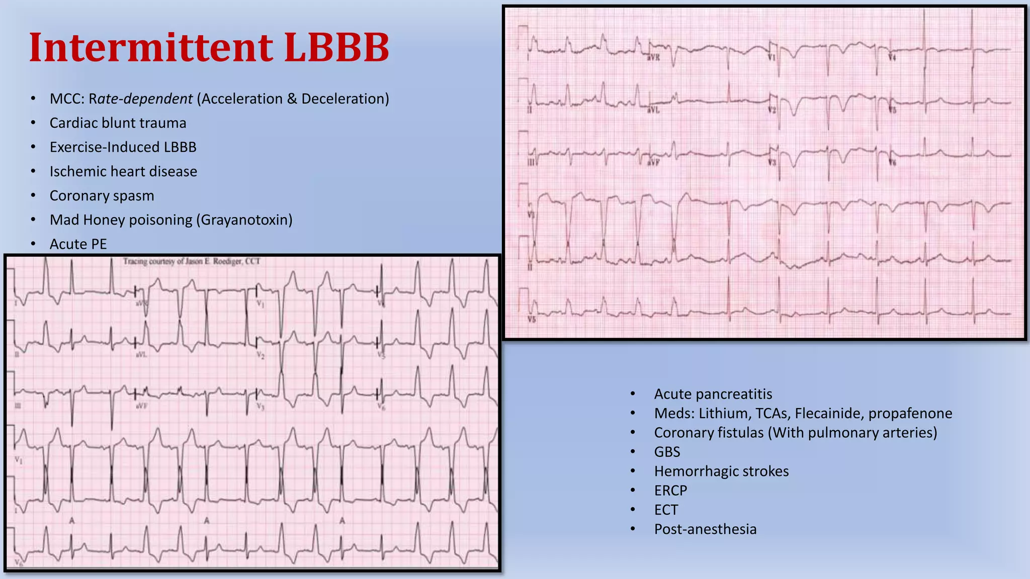 Left Bundle Branch Block (LBBB) | PPTX