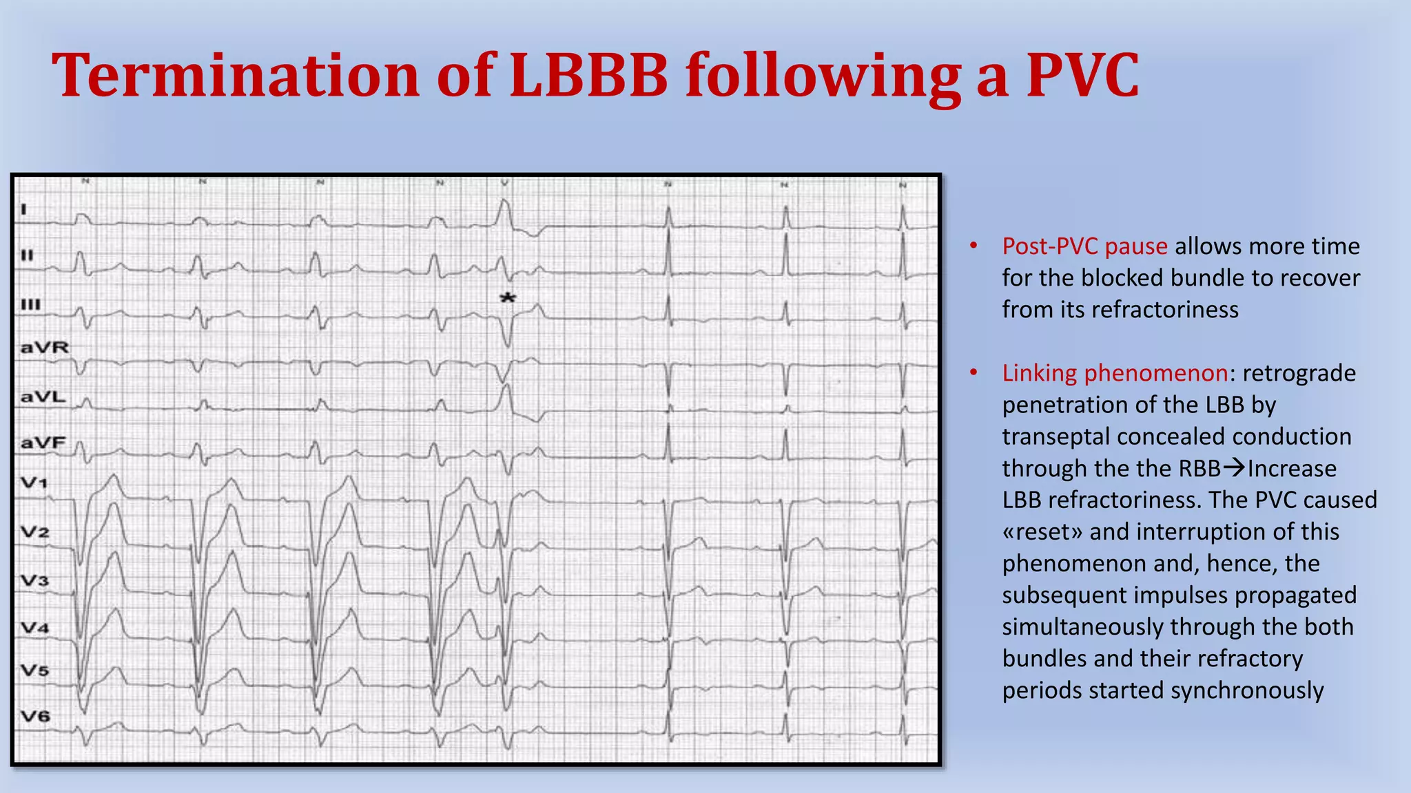 Left Bundle Branch Block (LBBB) | PPTX