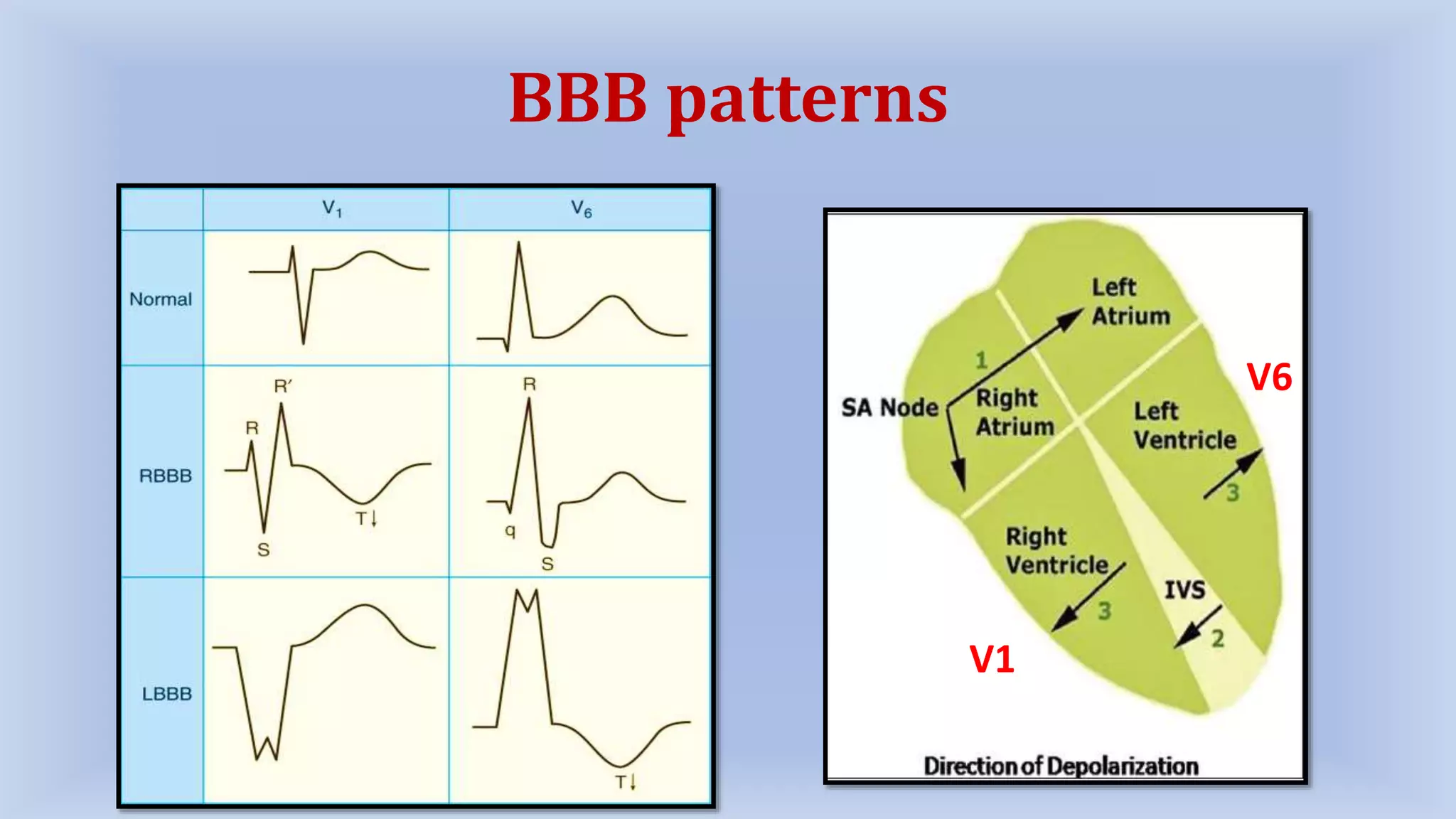 Left Bundle Branch Block (LBBB) | PPT