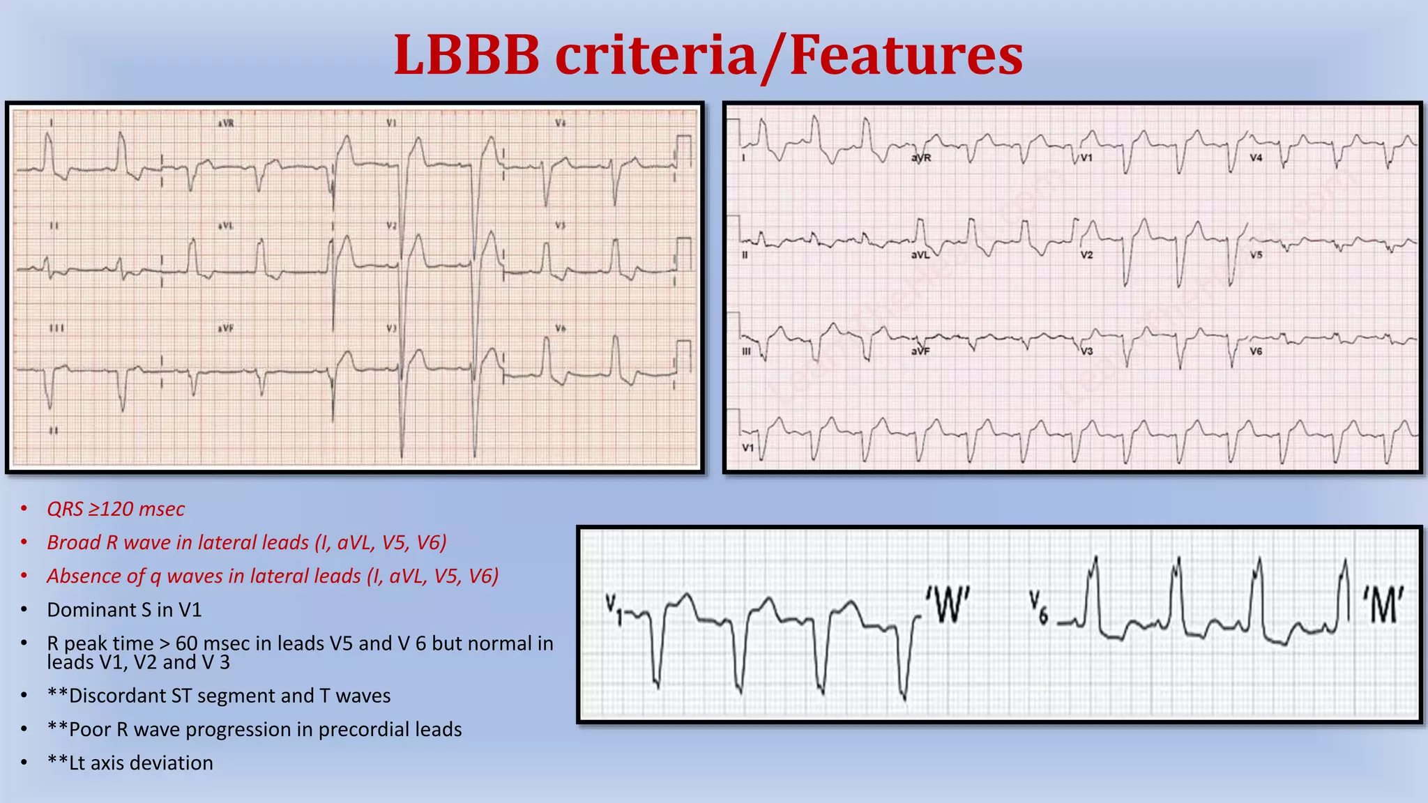 Left Bundle Branch Block (LBBB) | PPTX