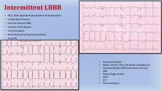 Left Bundle Branch Block (LBBB) | PPTX