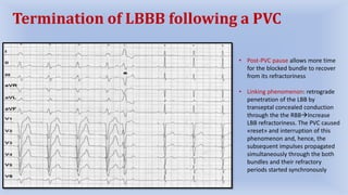 Left Bundle Branch Block (LBBB) | PPTX