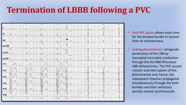 Left Bundle Branch Block (LBBB) | PPTX | Heart and Cardiovascular ...